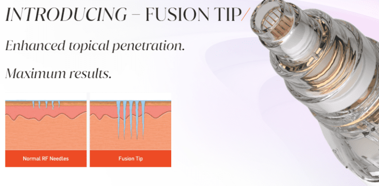 Potenza™ RF microneedling Ottawa | Your best skin | Skin Revival Clinic