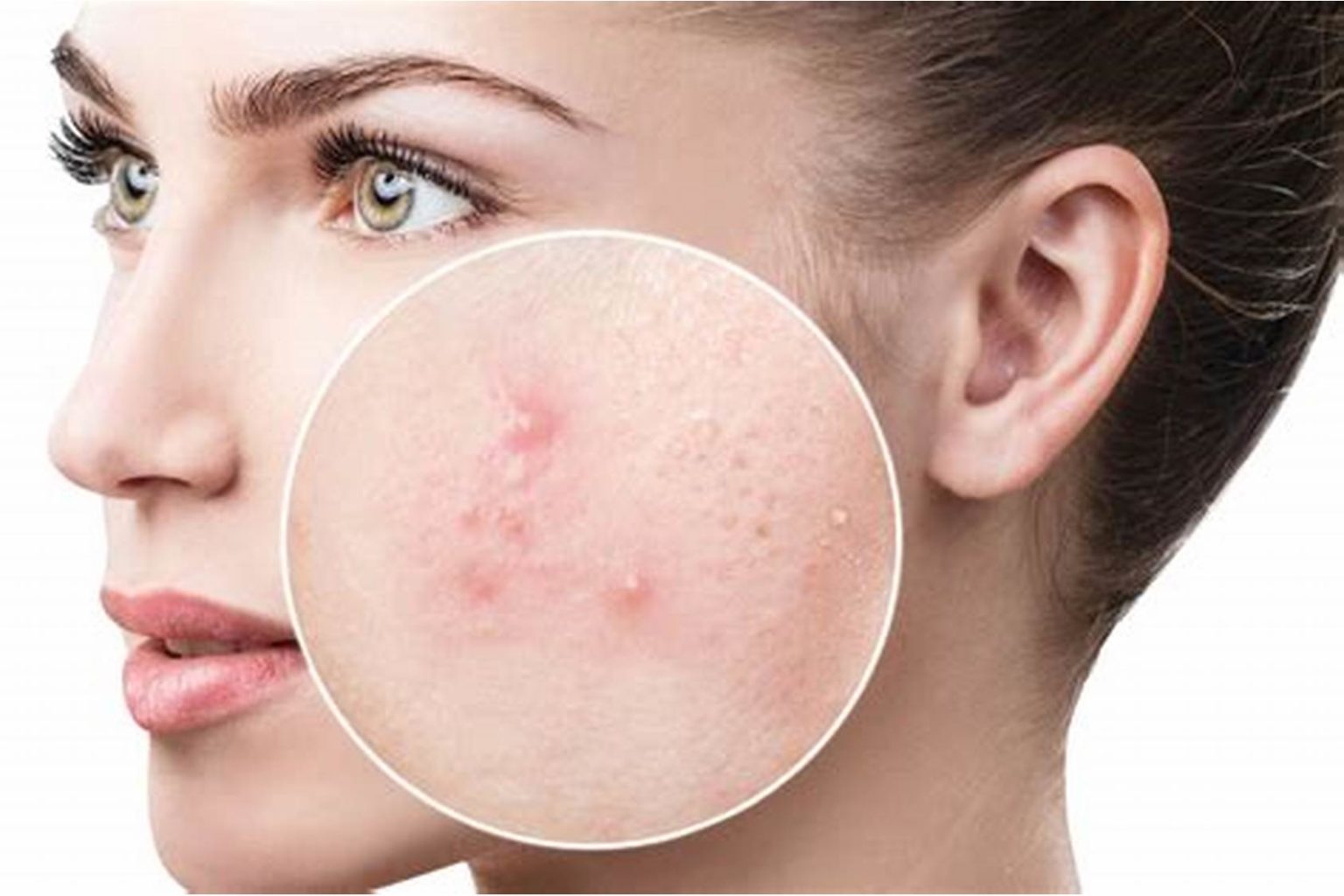 Sooo…you want to pick your pimples, do you?? - Skin Revival Clinic & Spa