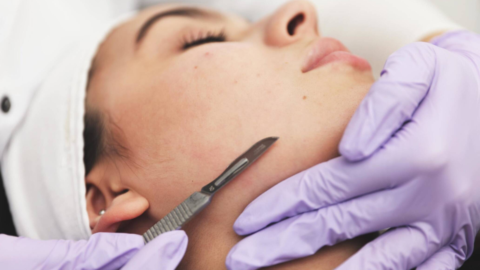 Microdermabrasion Ottawa | Skin Revival Clinic & Spa